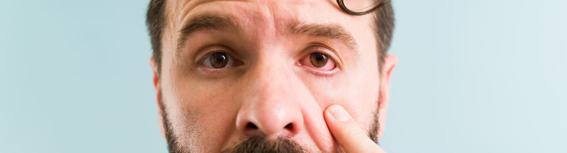 How to Get Rid of Red Eyes | Eye Society | 1-800 Contacts