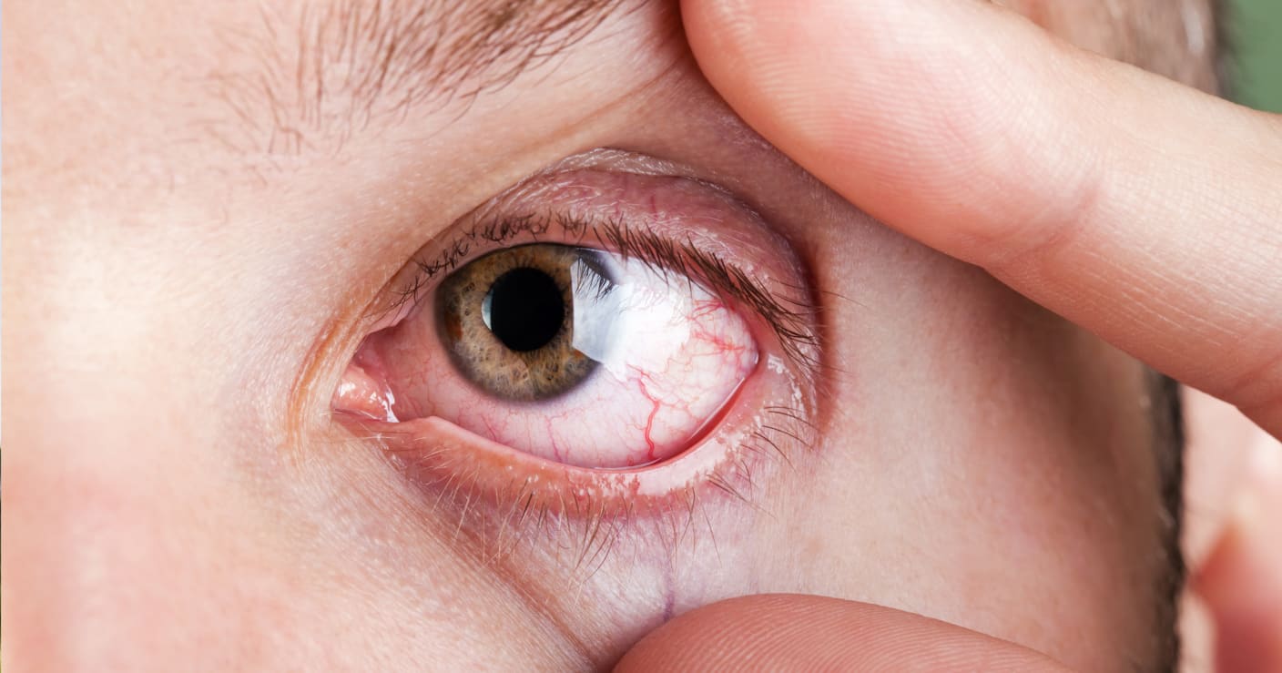 All About Blood Vessels Visible in Eyes | 1-800 Contacts