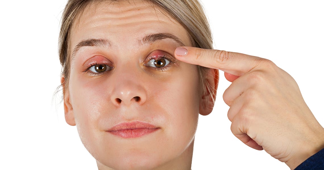 What is Chalazion? | Eye Society | 1-800 Contacts