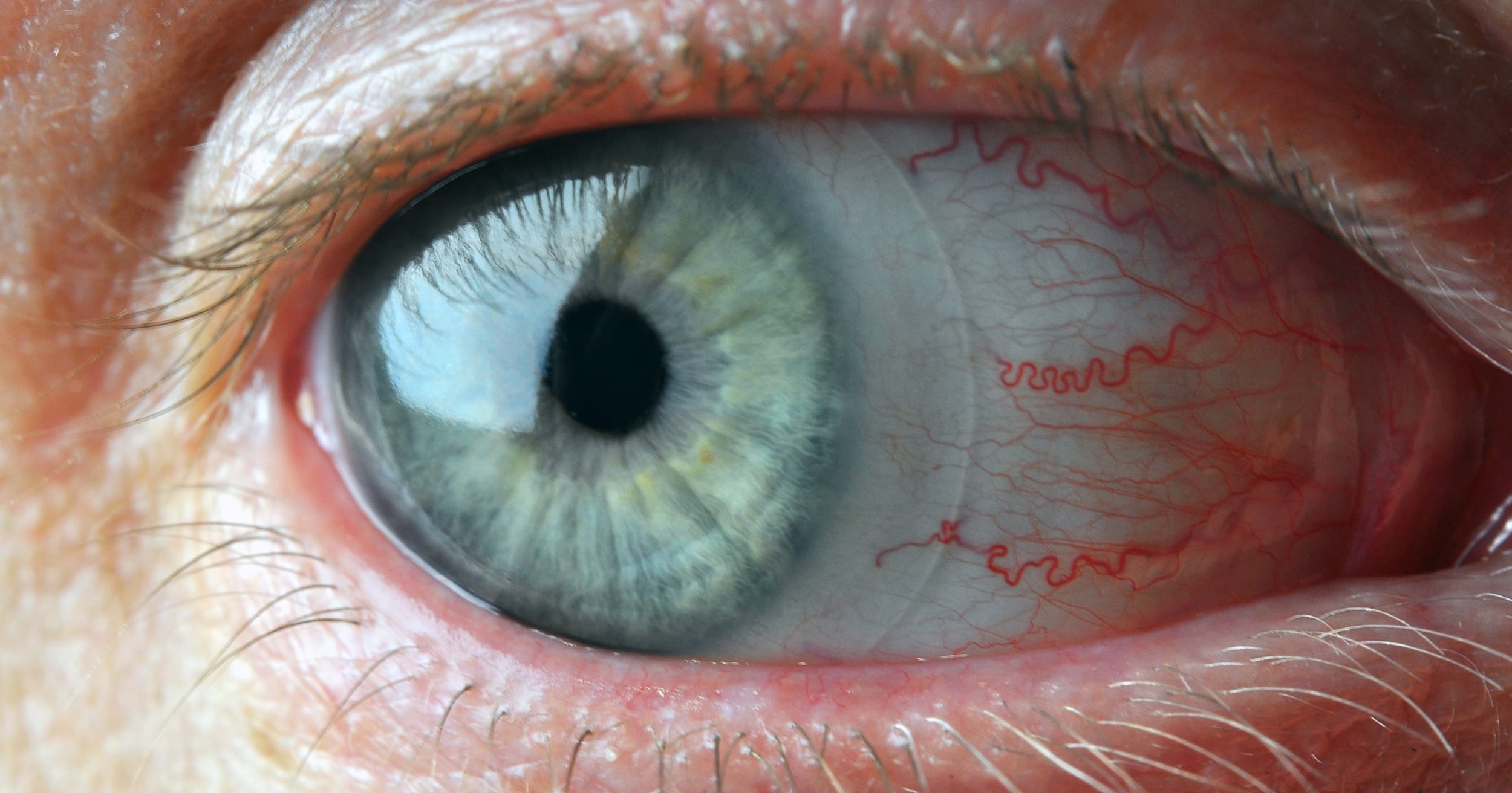 Why Do My Contacts Burn? | 1-800 Contacts